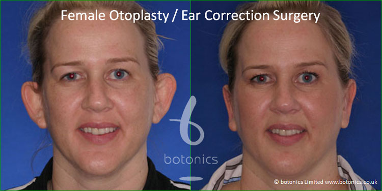 Bilateral Otoplasty Female - botonics Bilateral Otoplasty Female - botonics