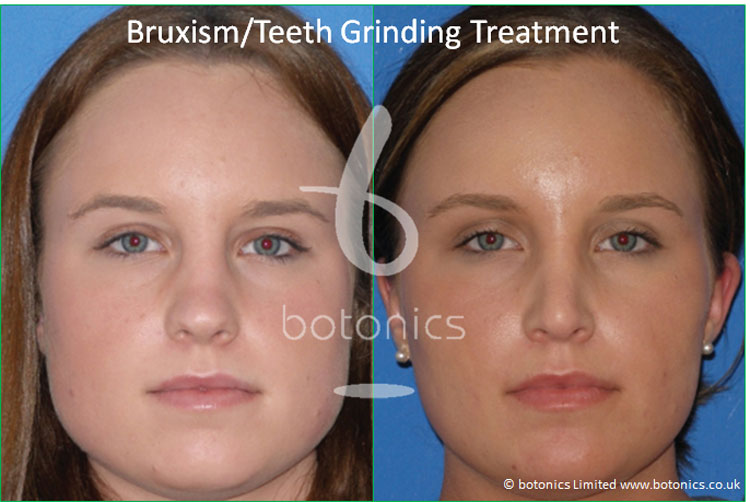 Bruxism Grinding Clenching Treatment With Botox Botonics