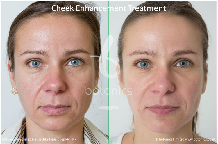 Cheek Fillers Before and After Pictures - botonics UK