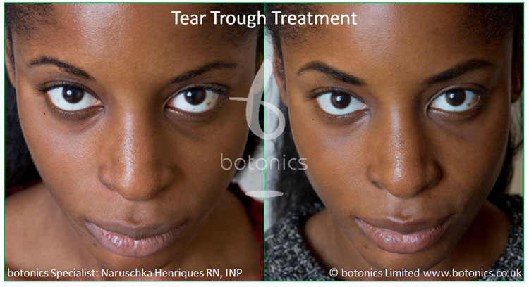 Tear Trough Young Model Botonics