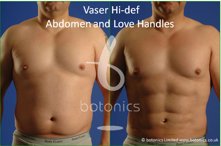 VASER™ Liposuction Before & After Photos UK