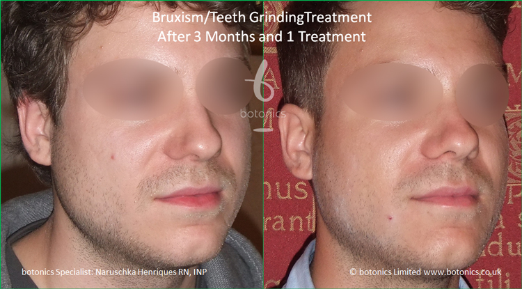 Bruxism Masseter Jaw Reduction With Botox Botonics
