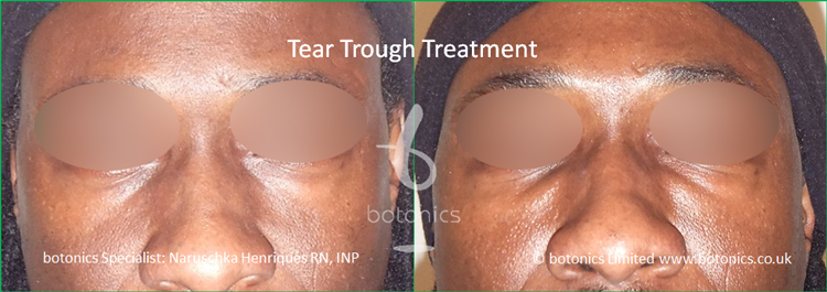 Tear Trough Fillers Before and After Photos Comparison in London, UK