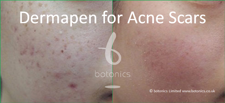 Dermapen & Dermaroller Before & After Photos Comparison in London UK