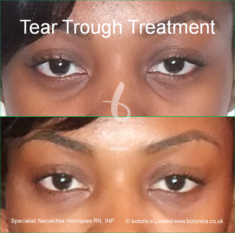 Tear Trough Fillers Before And After Photos Comparison In London Uk