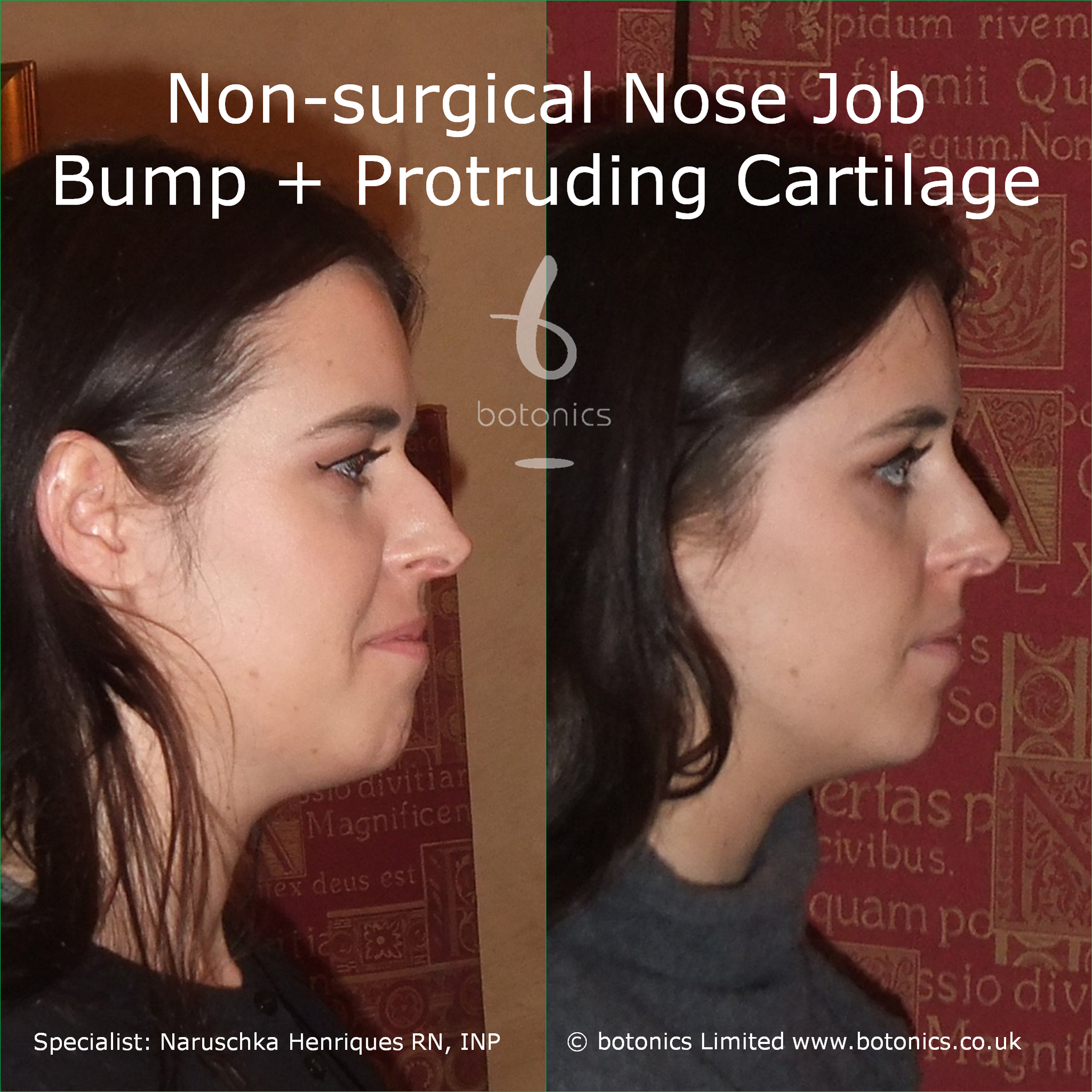 Non Surgical Nose Job Before And After Photos Comparison In London Uk