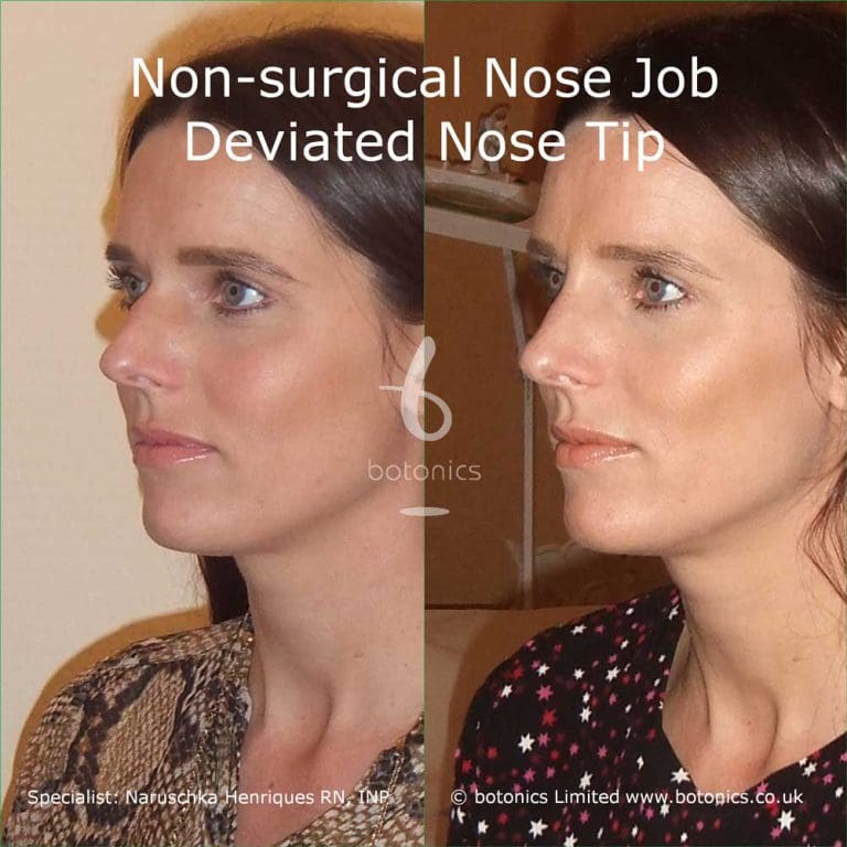 Non-Surgical Nose Job Before And After - botonics