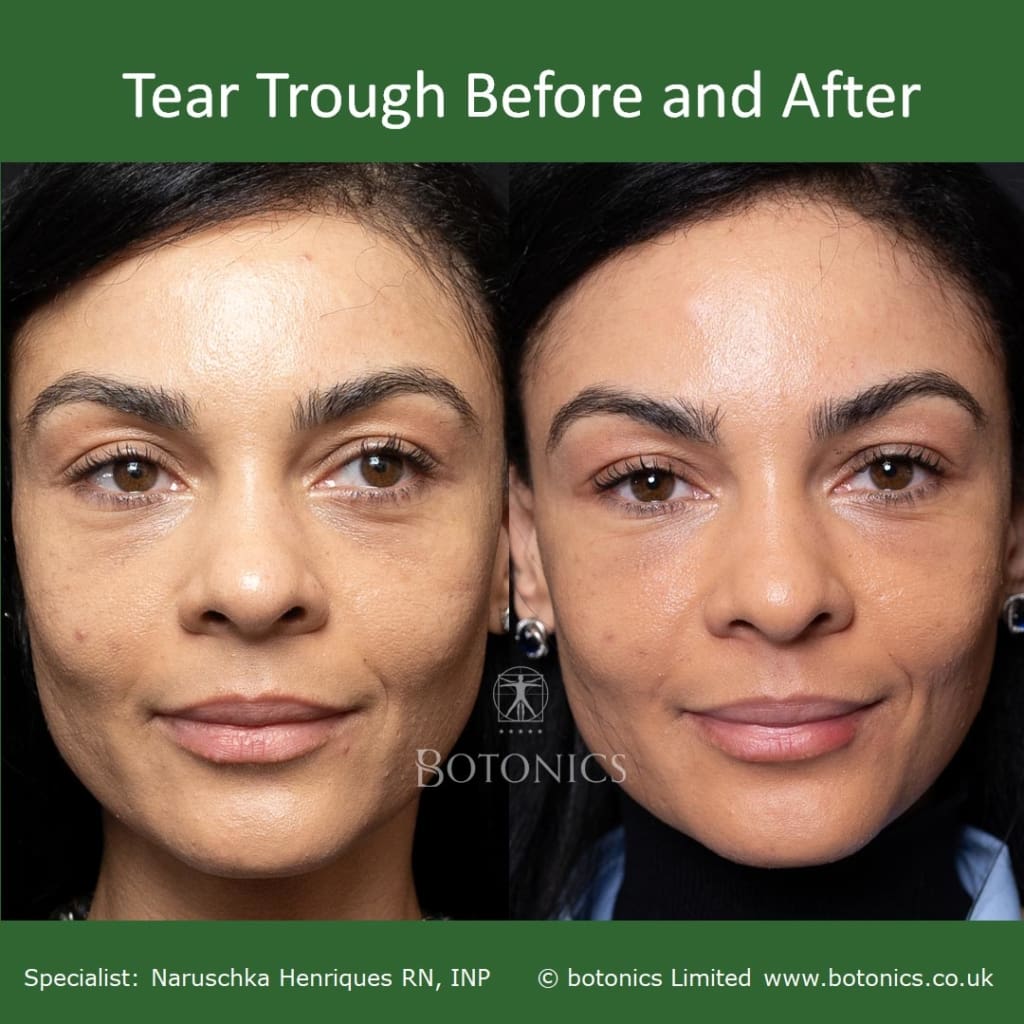 Tear Trough Fillers Before & After - botonics