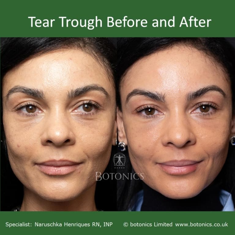 Tear Trough Fillers Before & After - botonics