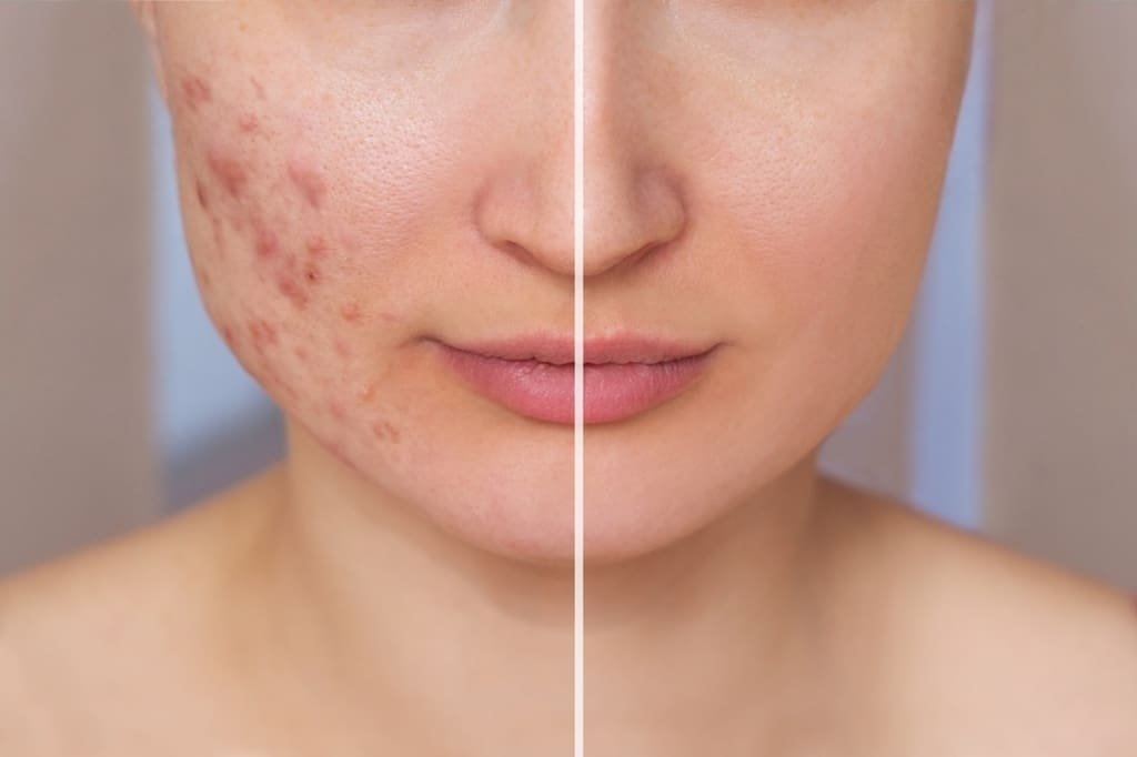 Roaccutane For Acne (Isotretinoin): A Complete Guide - Botonics