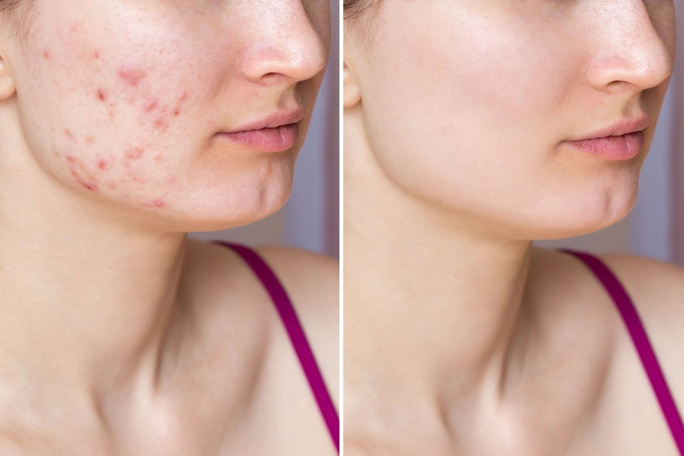 A Complete Guide To Roaccutane For Acne Isotretinoin Botonics